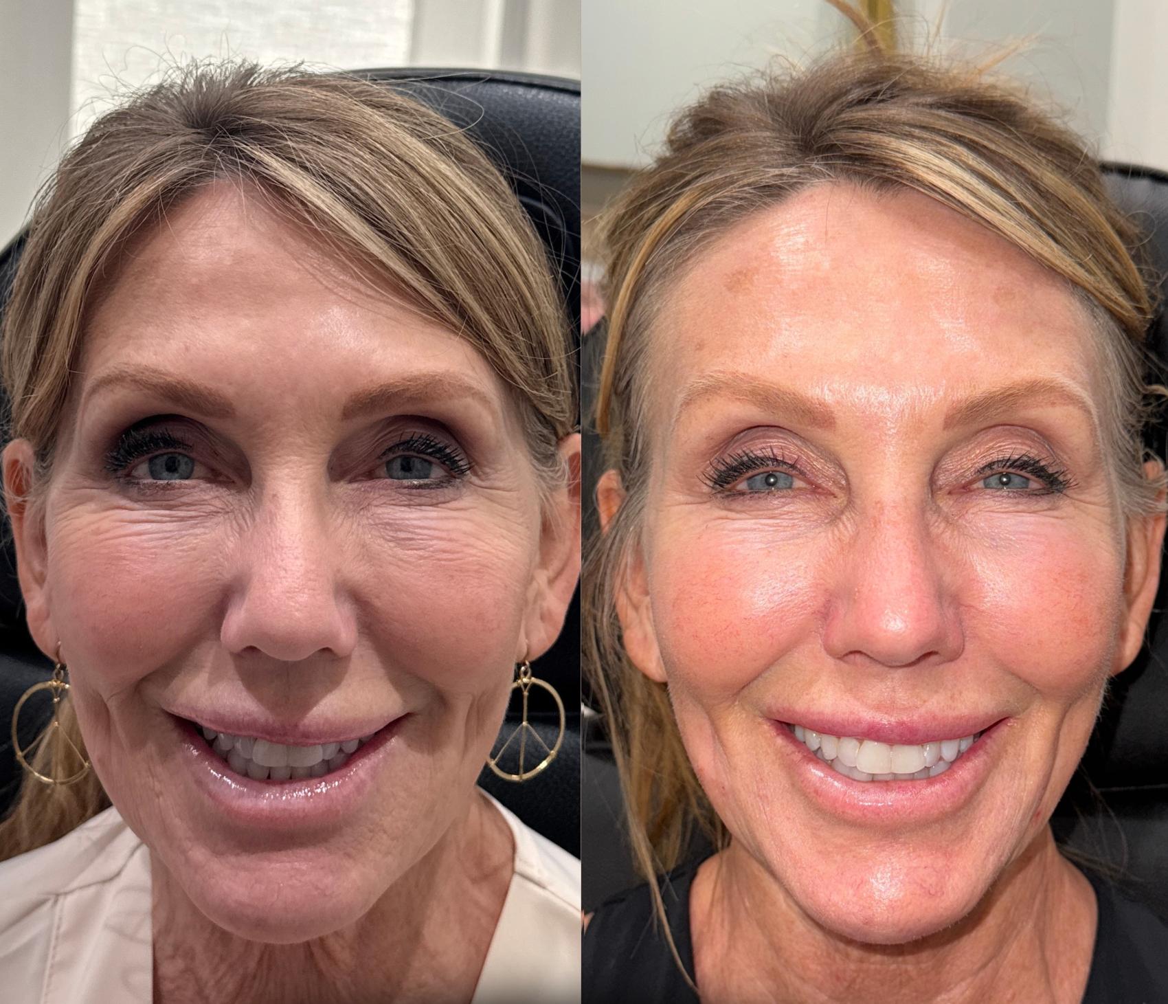 Dermal Fillers Before and After Pictures Case 222 | Sacramento, CA ...
