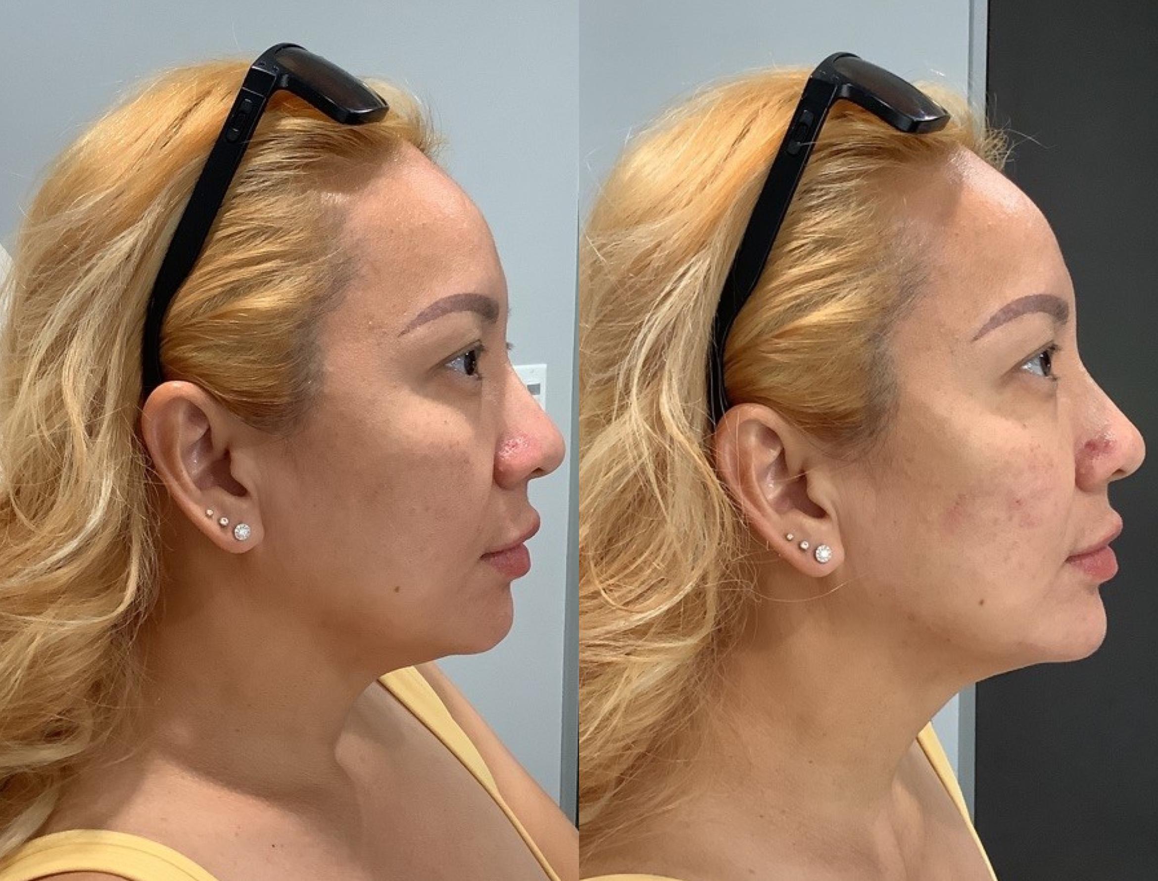 Dermal Fillers Before & After Photo Gallery | Elk Grove, Folsom ...
